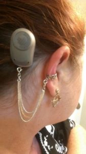 What is a BAHA/BAHS? | Ear Community