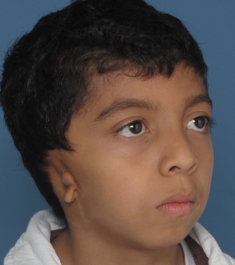 Right ear Microtia | Ear Community