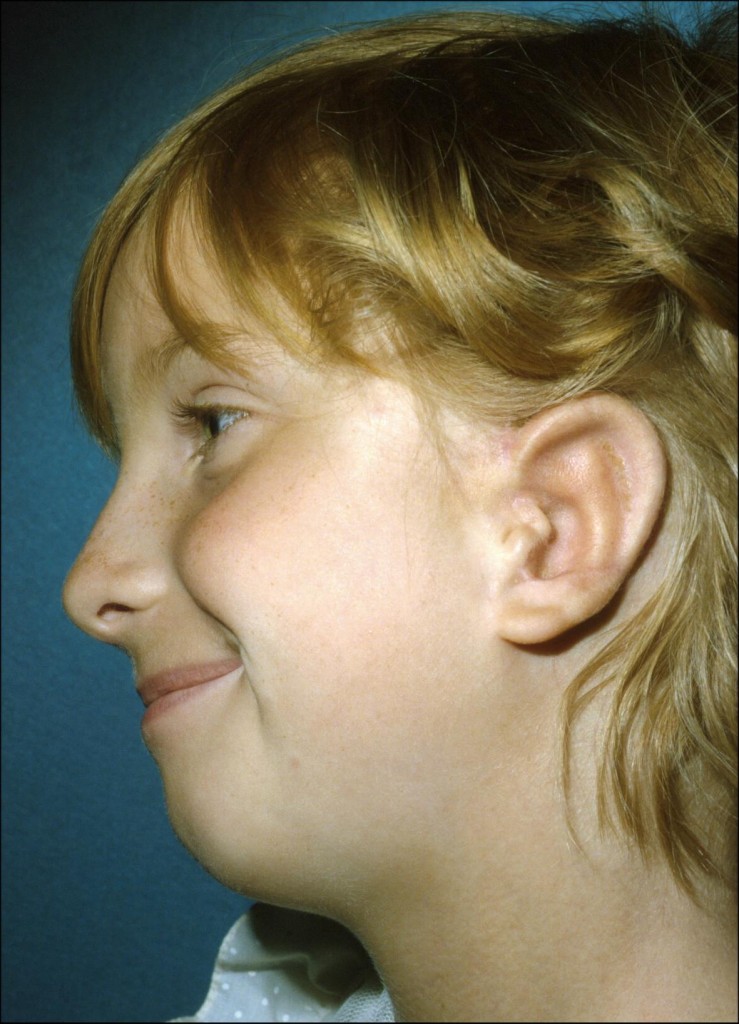 Patient 4, 1-year post-op | Ear Community